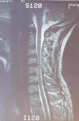 Spinal Disc Surgery